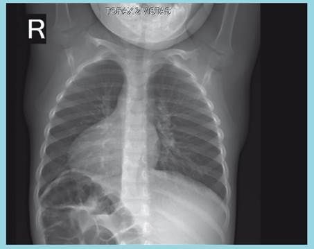 Print Froggy Jumps: Radiografías de RECIÉN NACIDOS (rayos x - tórax ...