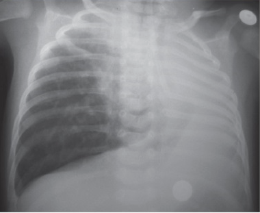 Print Froggy Jumps: Radiografías de RECIÉN NACIDOS (rayos x - tórax ...