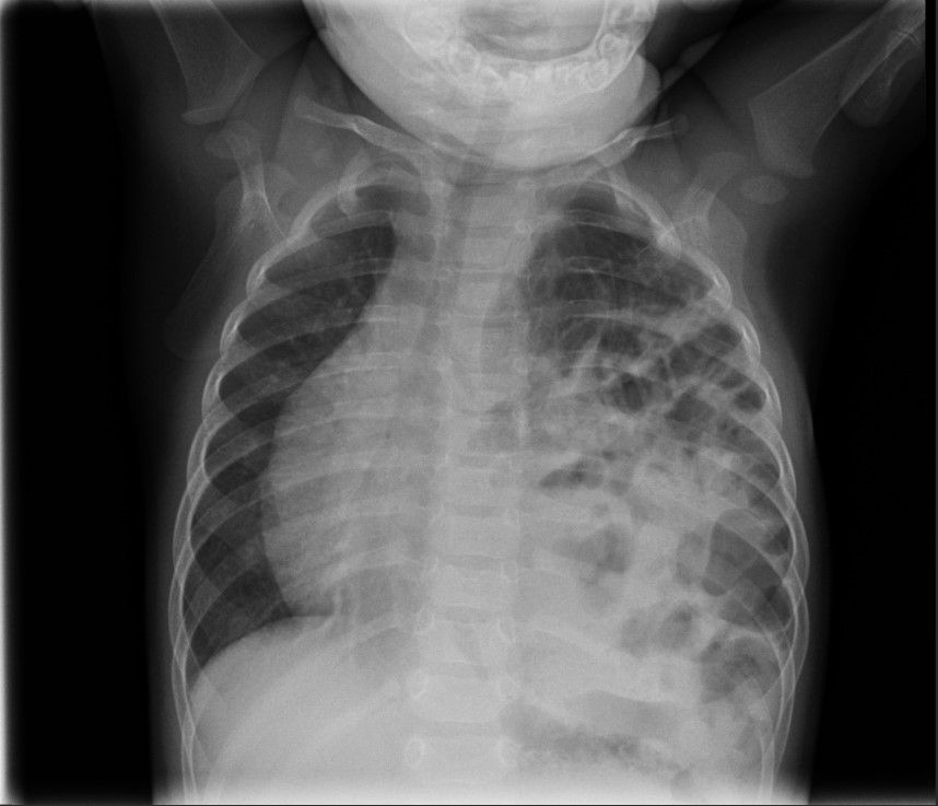 Print Froggy Jumps: Radiografías de RECIÉN NACIDOS (rayos x - tórax ...